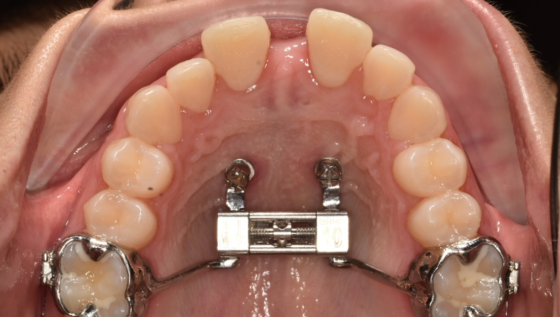 Advanced Mini Implant Applications: Discover the Infinitas Single Visi ...