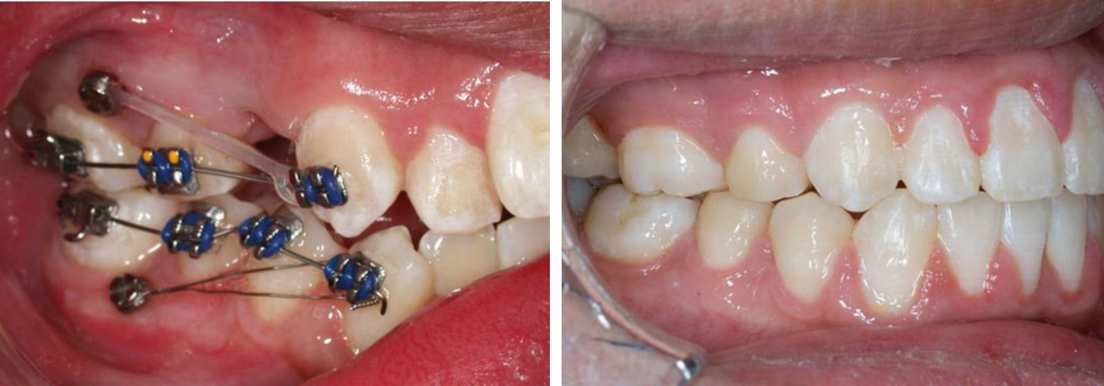 Reasons to Attend the Infinitas Mini-Implant Course: This Review and C ...