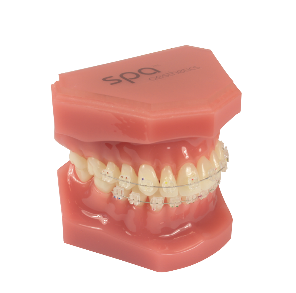 Spa Bracket Consultation Model – DB Orthodontics Limited