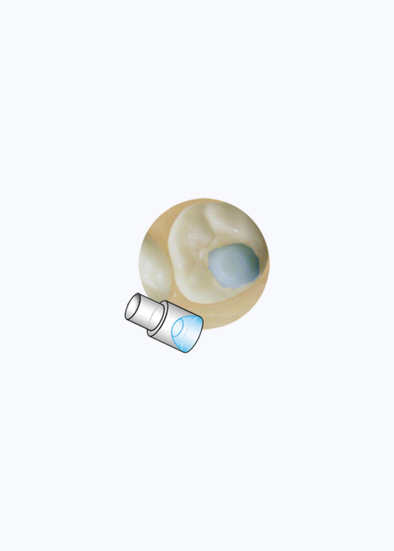 Posterior Molar Pad Mini-Mold Tips – DB Orthodontics Limited